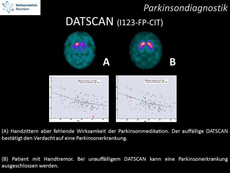 Parkinson-Diagnostik - Nuklearmedizin Neumann